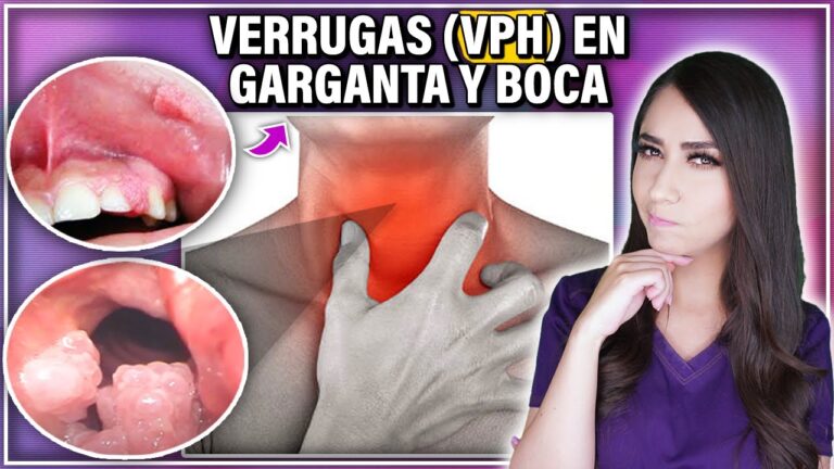 Todo lo que necesitas saber sobre los granitos en el paladar y garganta ...