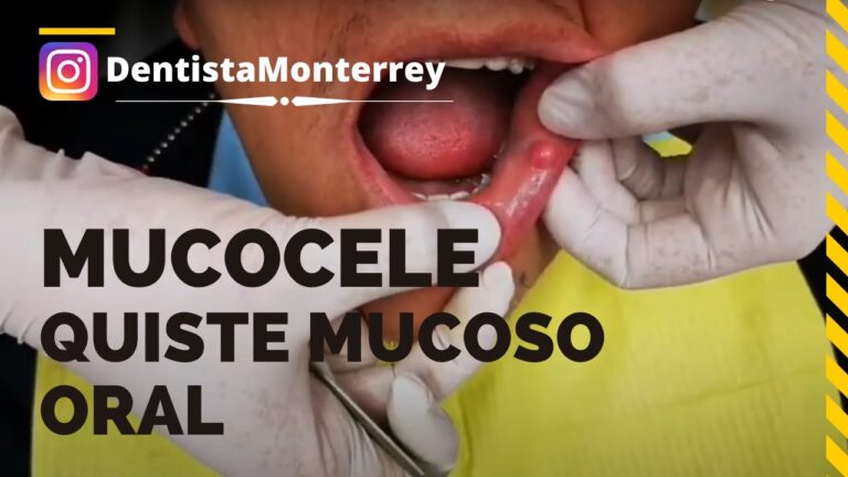 Descubre todo sobre el mucocele en la boca: causas, síntomas y ...