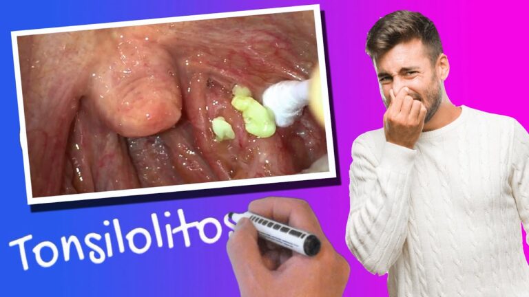 Descubre qué son las bolitas que salen en la boca y cómo tratarlas ...