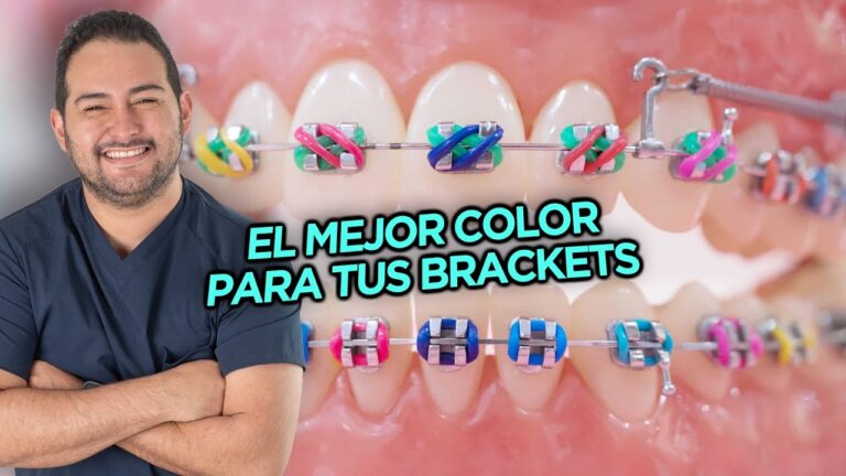 Descubre cuál es el mejor color de brackets para mujeres: Guía completa ...