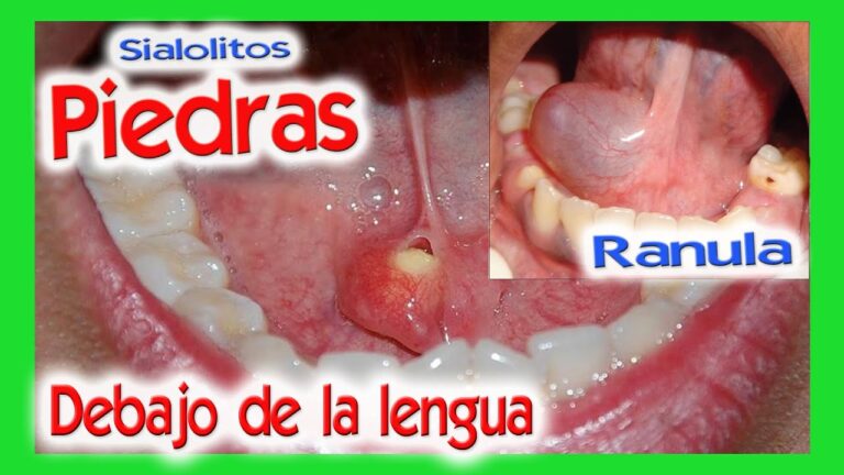 Descubre por qué salen bolitas debajo de la lengua y cómo tratarlas ...