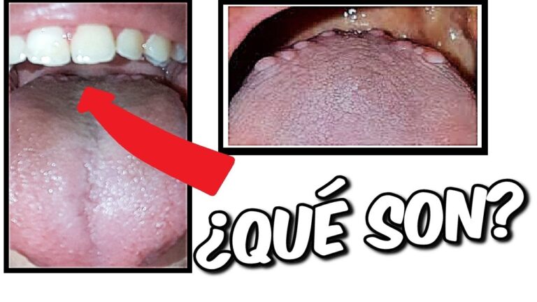 Descubre qué significa tener bolitas en la lengua y cómo tratarlas ...