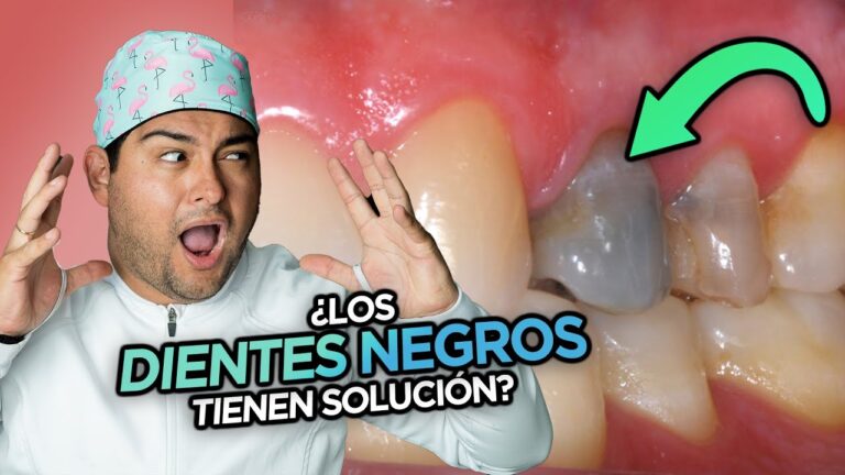 Descubre cómo salvar un diente negro: consejos y tratamientos efectivos ...