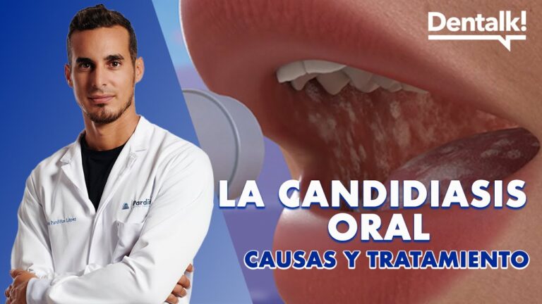Síntomas de Candidiasis en la Boca: Todo lo que Debes Saber para ...