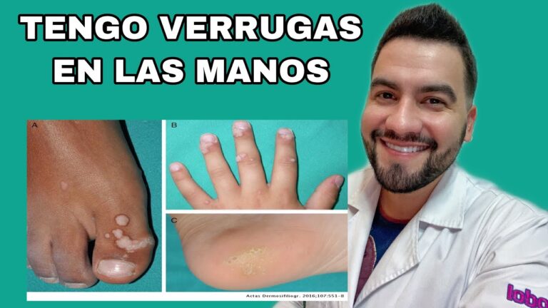 Verruga en los dedos de las manos: Causas, síntomas y tratamientos que ...